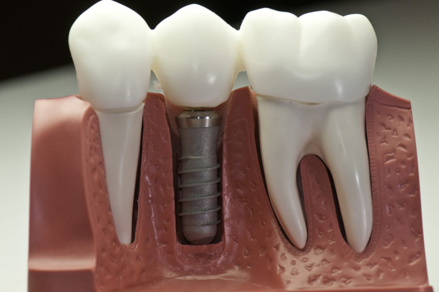 What Makes Dental Implants the "Gold Standard?"